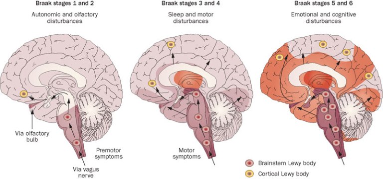 A new theory of Parkinson’s disease – The Science of Parkinson's