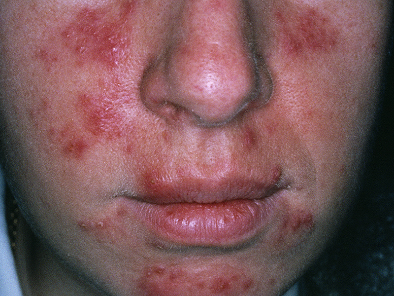 Another connection between skin and Parkinson’s disease – The Science ...