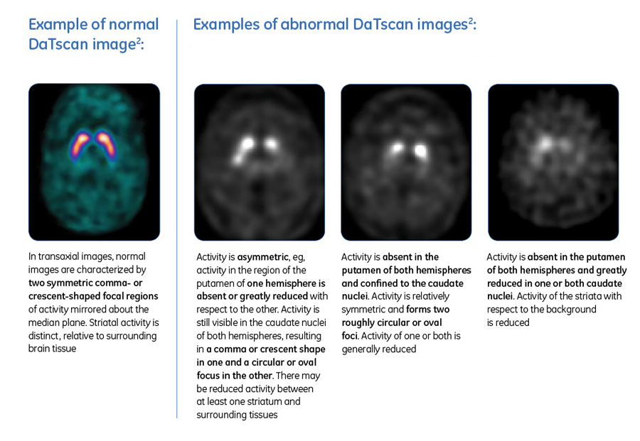 June 2016 – The Science of Parkinson's