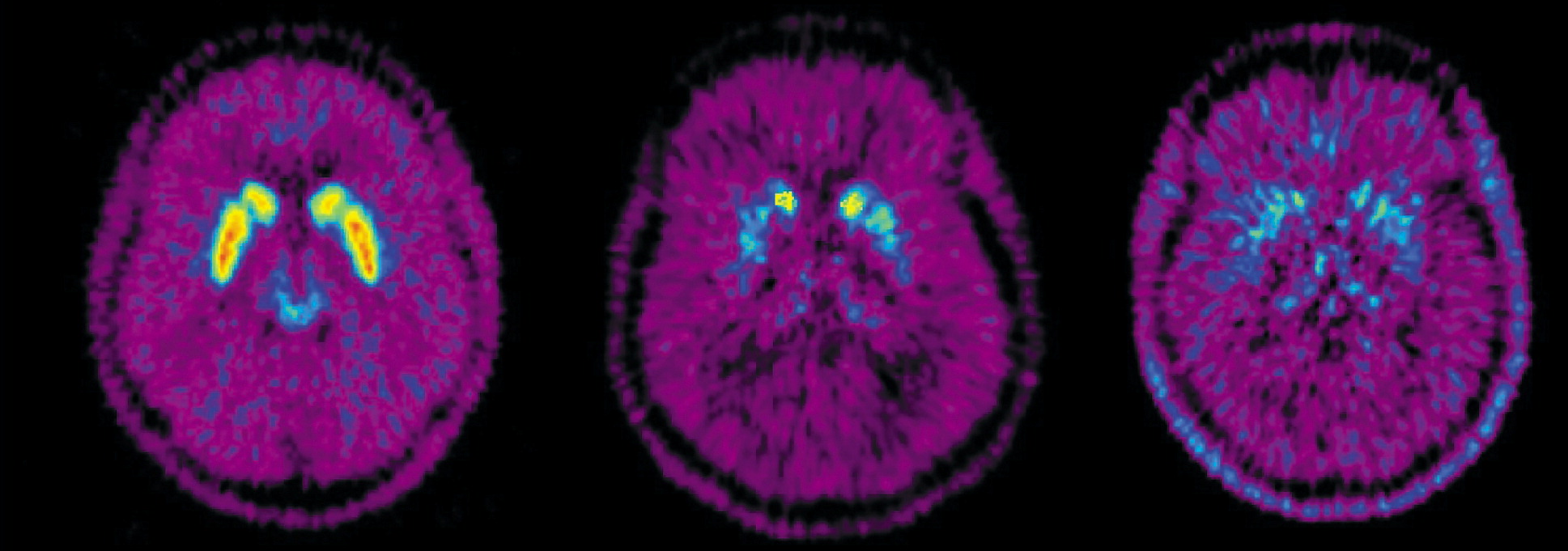New criteria for Parkinson’s disease – The Science of Parkinson's