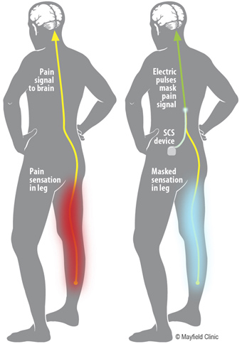 Spine-tingling research – The Science of Parkinson's