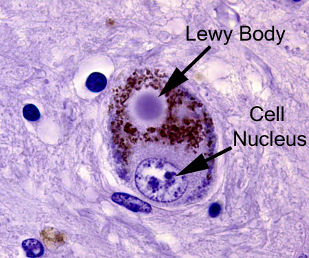 Dementia with Lewy Bodies: New recommendations – The Science of Parkinson's