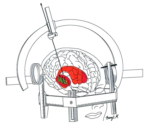 When Bluerock became Bayer – The Science of Parkinson's
