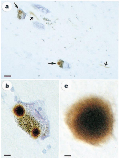 The other anniversary: 20 years of Alpha Synuclein – The Science of ...