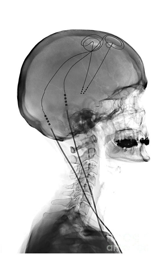 DBS: location, location, location – The Science of Parkinson's