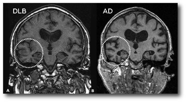 Dementia with Lewy Bodies: New recommendations – The Science of Parkinson's