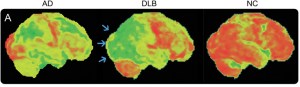 Dementia with Lewy Bodies: New recommendations – The Science of Parkinson's