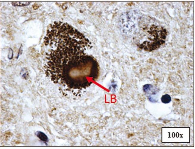 The TAU of Parkinson’s – The Science of Parkinson's
