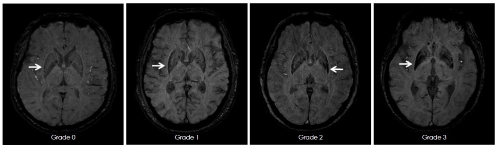 Differentiating PD from MSA – The Science of Parkinson's