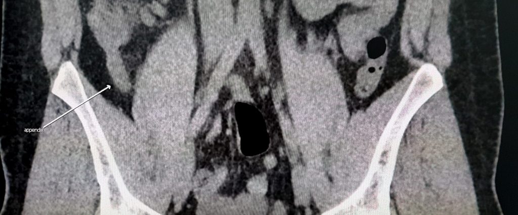 The potential benefits of missing an appendix – The Science of Parkinson's