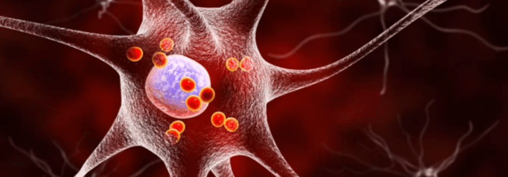 Differentiating PD from MSA – The Science of Parkinson's