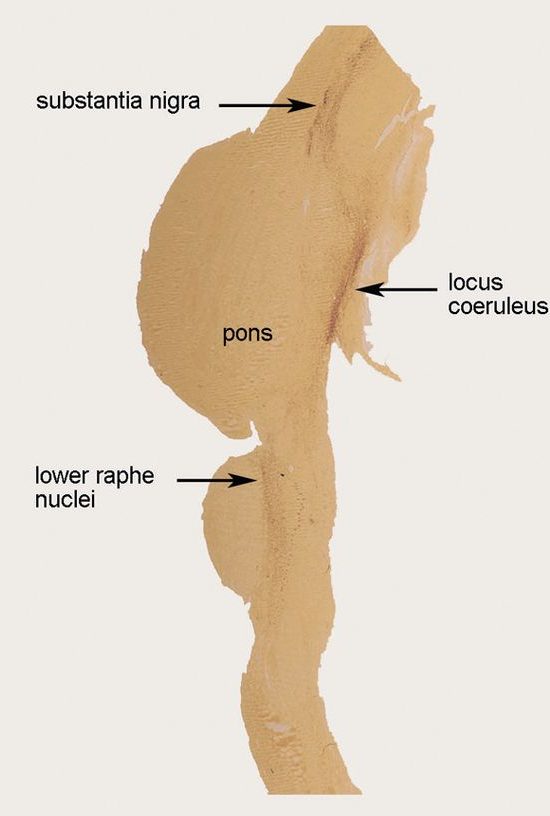 Curasen: Shifting the focus from just dopamine – The Science of Parkinson's